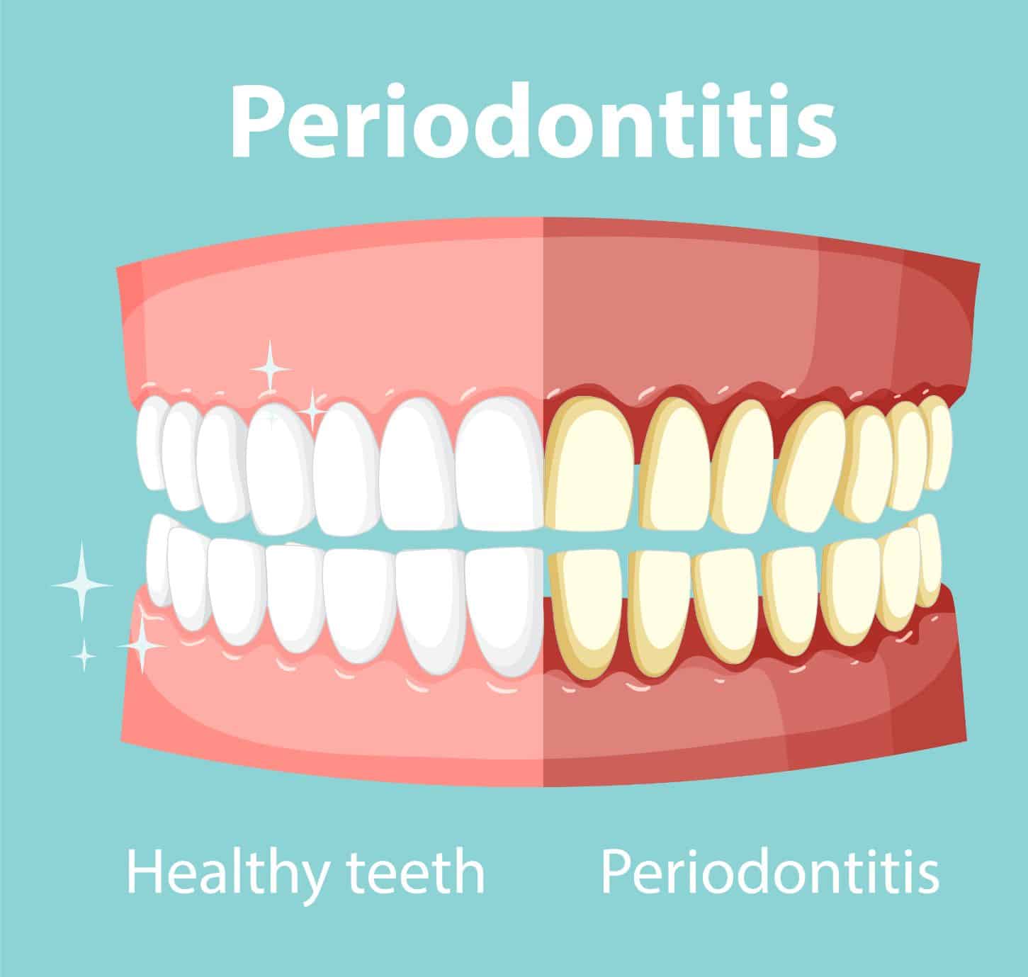 Teeth Cleaning Guide: How A Deep Clean Help with Gum Disease